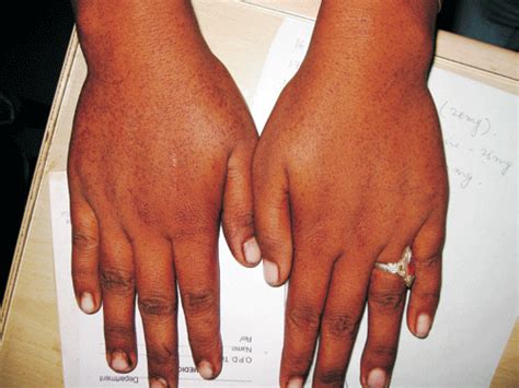 Reticulate Acropigmentation Of Kitamura