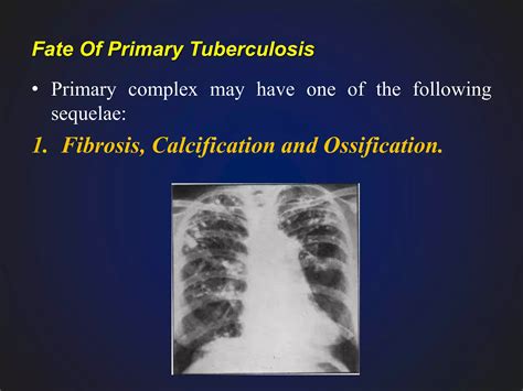 Tuberculosis Pptx