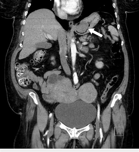 Figure 1 From Open Gastrostomy Of A Gastric Leiomyoma Proximal To The