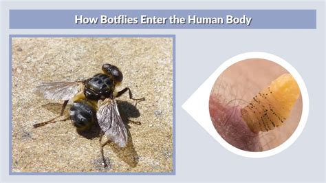 Human Botfly Infestation Symptoms Removal And Prevention
