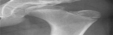 Reliability Of Bucholz And Ogden Classification For Osteonec Clinical Orthopaedics And