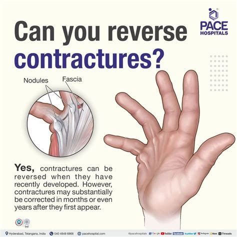 Contractures Burncontractures Muscletightening Postburncontracture