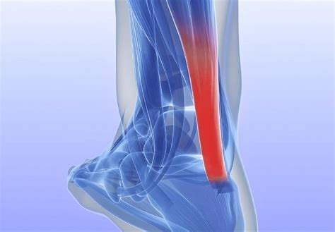 Diagnosis Of Mortons Neuroma Footankleaz
