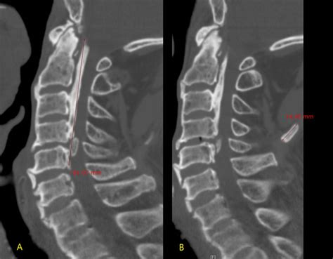 Posterior Longitudinal Ligament Calcification