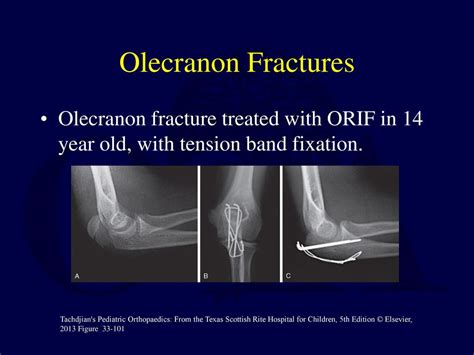 Fractures And Dislocations About The Elbow In The Pediatric Patient