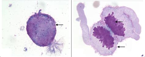 Csf Cytology Wrights Staining × 400 Showing Malignant Cells 2 1 Download Scientific
