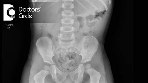 Intussusception Claw Sign