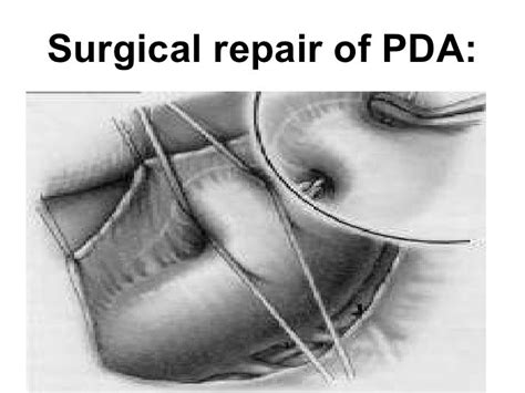 Management Of Pda