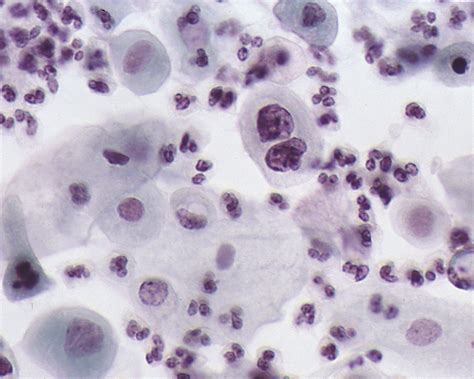 Fig 426 Atypical Squamous Cells Cannot Exclude A High Grade Squamous Intraepithelial Lesion