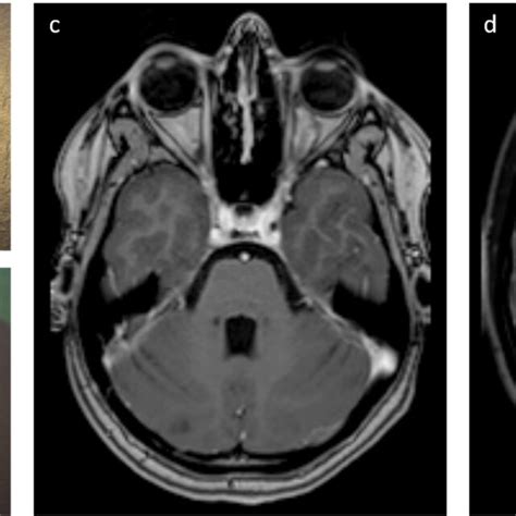 Pes Cavus Deformity In Daughter A And Mother B With A Pathogenic