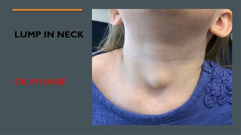 Neck Lump And Sinusitis Ggdgdgfdgsdgsdfgsdgfpptx