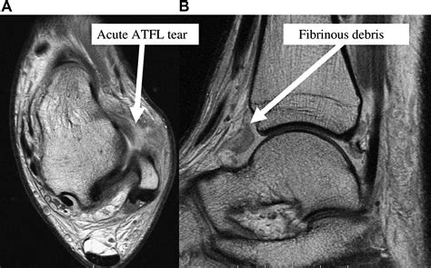 Mr Imaging Of Ankle Impingement Lesions Magnetic Resonance Imaging