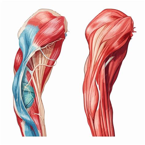Comparison Of Healthy And Ruptured Biceps Tendon Medical Illustration