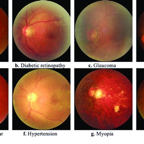 Fundus Images With Diagnostic Keywords And Associated Ocular Diseases