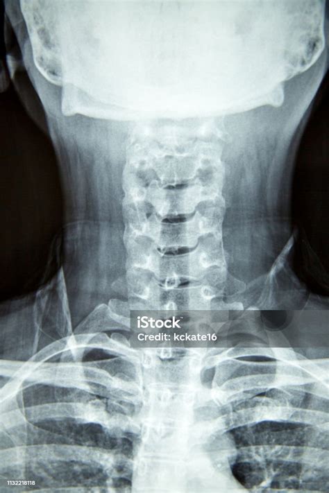 Close Up Xray Film Show Cervical Spine Or Cspine Neck Bones Xray Film