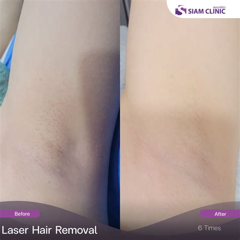 Hair Removal Laser Before And After Photos Siam Clinic Thailand