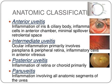 Anterior Uveitis