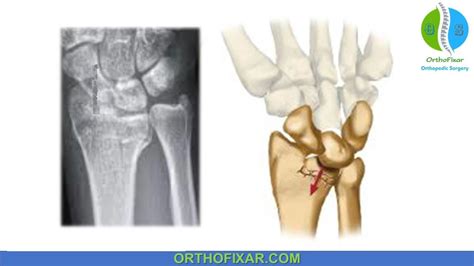 Die Punch Fracture