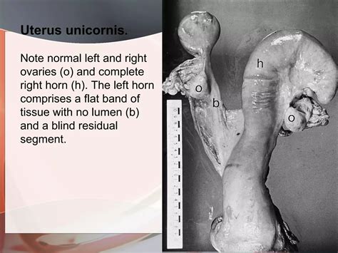 Pelvimetry Pelvic Abnormalities Congenital Defects Of Female Rep Tract Ppt