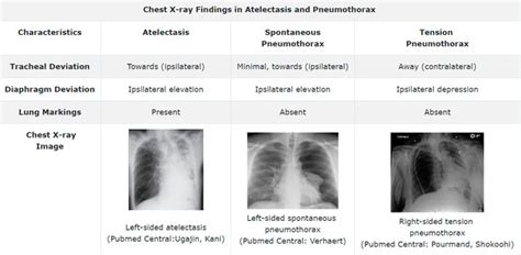 Atelectasis Vs Pneumothorax