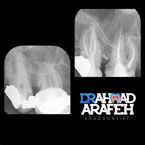 Ahmad Arafeh On Linkedin Endodontic