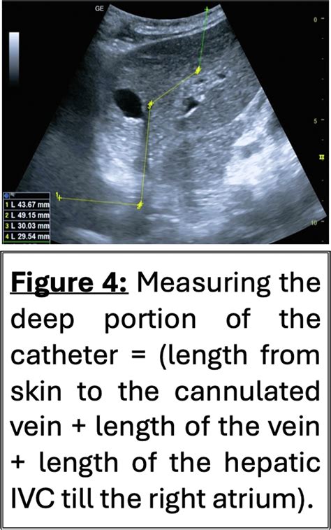 Wcn26 5036 Ultrasound Guided Insertion Of Transhepatic Hemodialysis