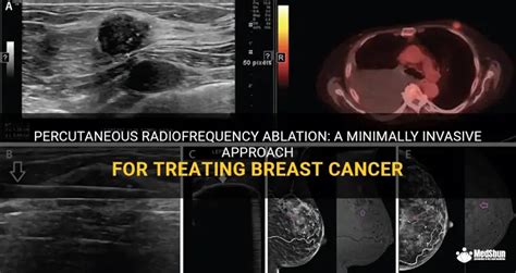 Percutaneous Radiofrequency Ablation A Minimally Invasive Approach For Treating Breast Cancer
