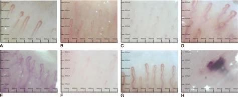 Nailfold Capillary Abnormalities Are Associated With Type 2 Medicine