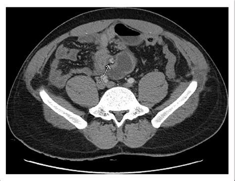 Calcification In The Mesenteric Root At Ct Scan Download Scientific Diagram