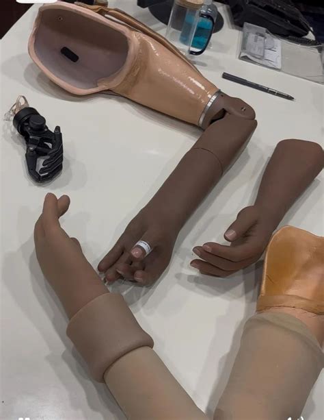 Upper Limb Above Elbow Prosthesis At ₹ 230000 Piece In New Delhi Id
