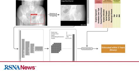 After The First Fda Approved Total Hip Arthroplasty Tha Was Performed At Mayo Clinic In 1969