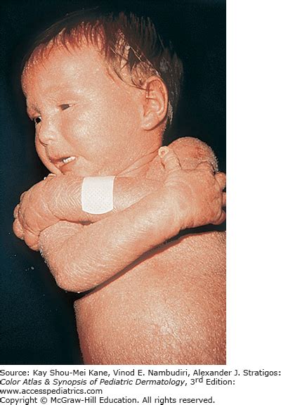 Disorders Of Epidermal Proliferation Obgyn Key