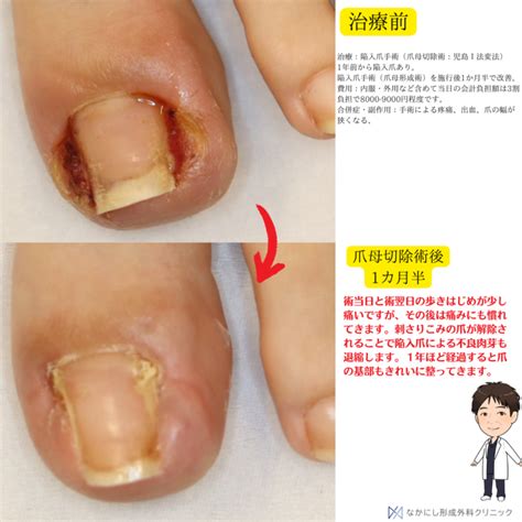 陥入爪の爪母切除術｜なかにし︎形成外科クリニック｜近鉄生駒駅の形成外科・美容皮膚科