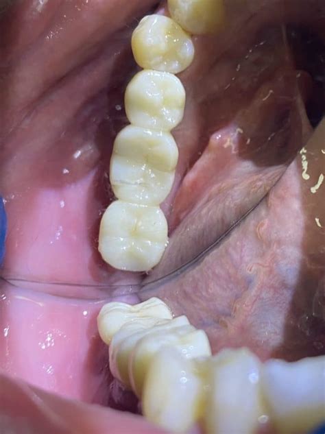 3 Dental Implants With Vertical And Horizontal Bone Block Graft Augmentation Case 3797