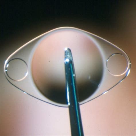 History Of Iris Fixation