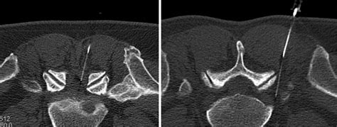 Effective Dose Of Ct Guided Epidural And Periradicular Injections Of
