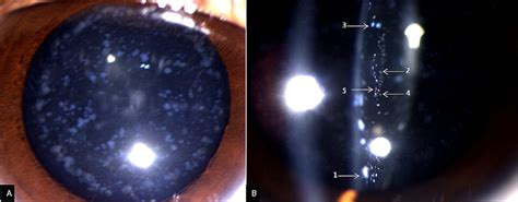 Blue Dot Cataract Causes