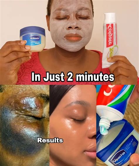 Uncover The Viral Toothpaste And Vaseline Skincare Secret Thats Taking
