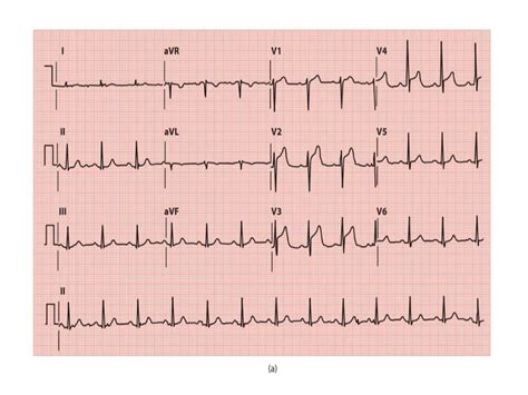 St Segment In Ecg St Elevation And St Depression Pptx