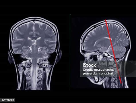 Mri Brain Scan Compare Coronal And Sagittal Plane For Detect Brain
