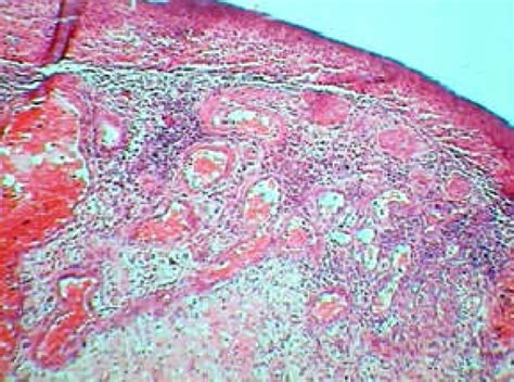 Unusual Presentation Of Chronic Hyperplastic Pulpitis A Case Report Pmc