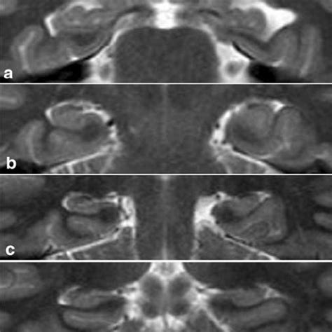 A C Unilateral Incomplete Hippocampal Inversion Rounded Or Pyramidal