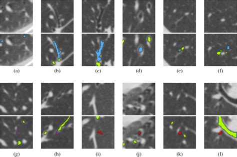 2d Ct Image Patches And The Overlaps With Rendered Airway Download
