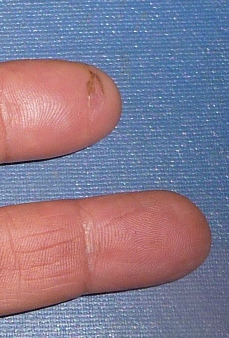 Homeopathic Treatment For Cat Bites