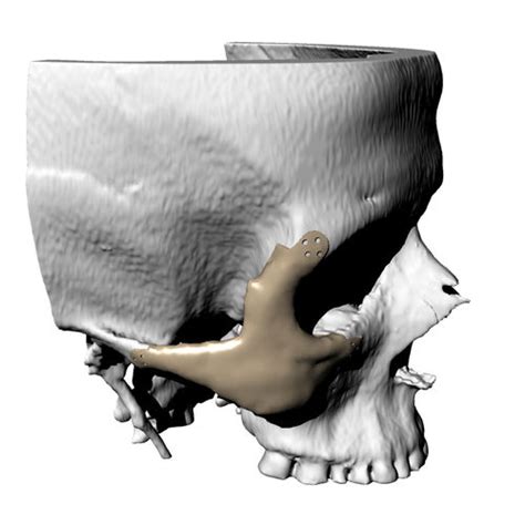 Custom Made Periorbital Implant Kune Implants Non Absorbable