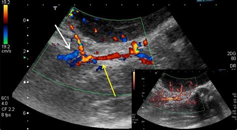 Rapidly Involuting Congenital Haemangioma Adc Fetal And Neonatal Edition