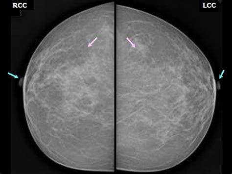 Look Like What Do Abnormal Mammograms Benign Vs Malignant