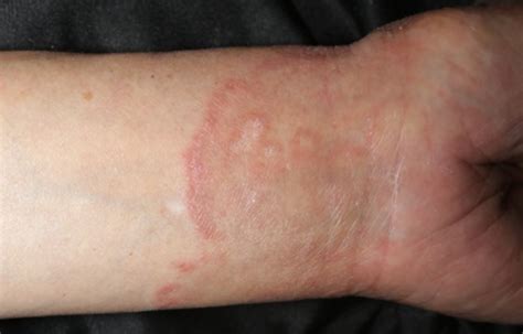 Fungal Infection Scrotum