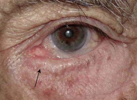 Angular Blepharoconjunctivitis