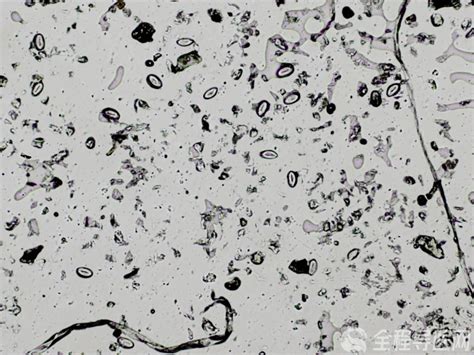 徐州市疾控中心开展儿童蛲虫感染专项监测工作 全程导医网